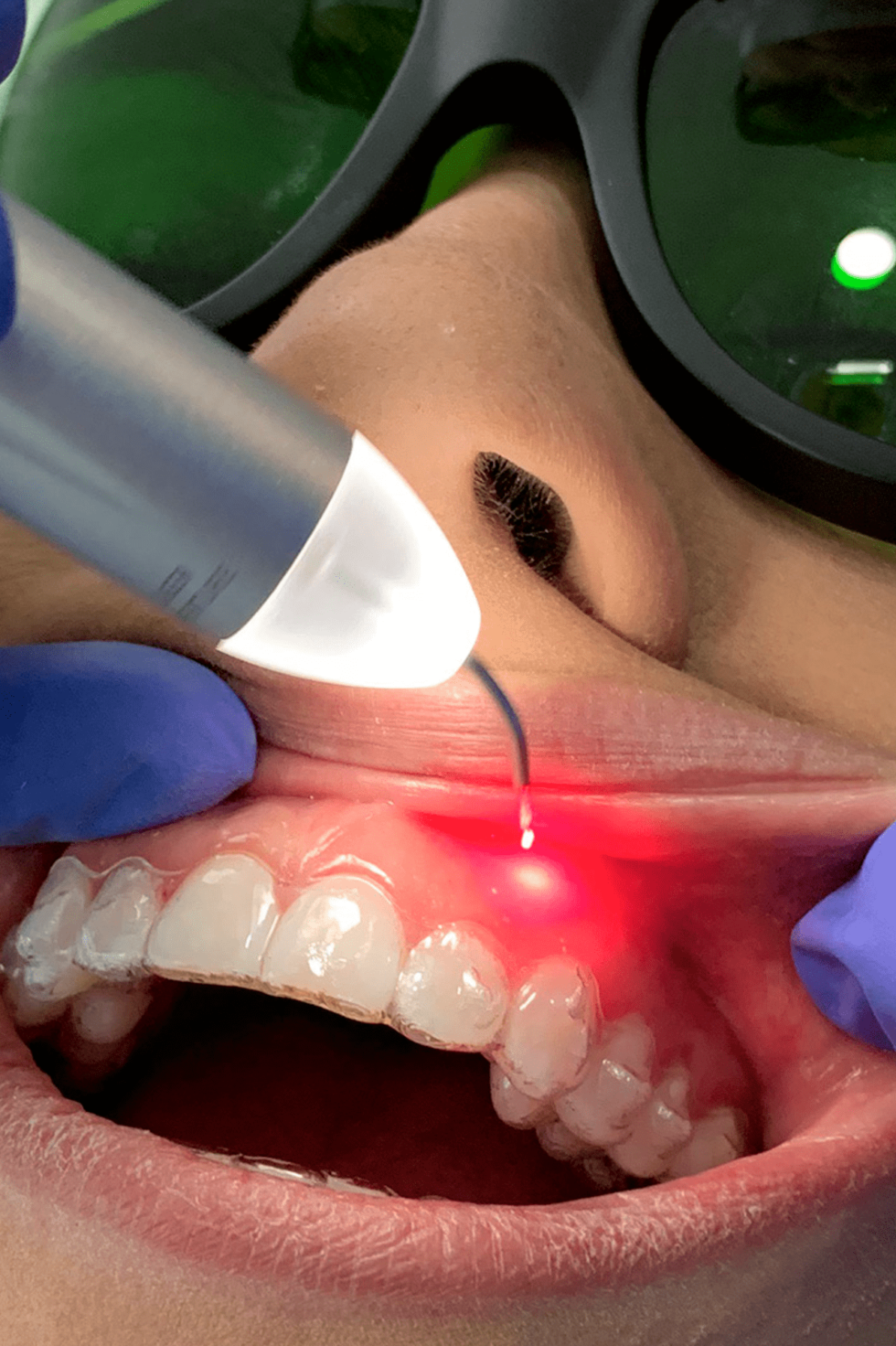 Odontología Láser - DentiLaser Smile